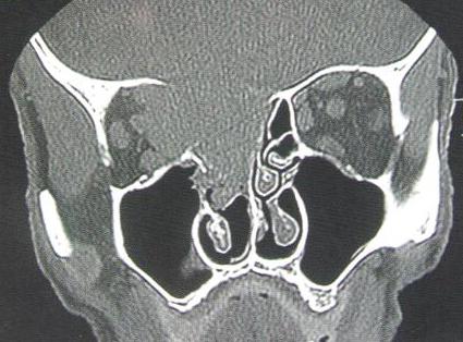 Carcinoma De Senos Paranasales Con Invasión Intracraneal TAC – Dr ...